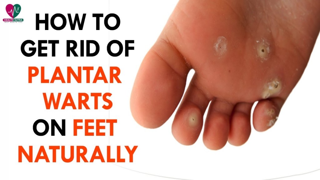 How To Get Rid Of Plantar Warts On Feet By natural means - Health and ...